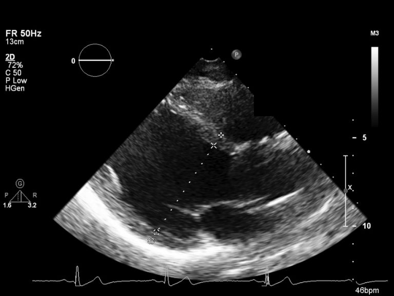 Echocardiography - Dr Sukhjinder Nijjer