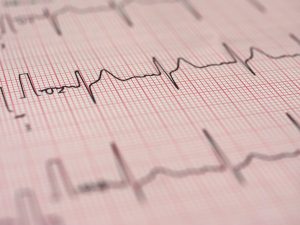 Ectopic Beats | Learn what they are & how you stop them