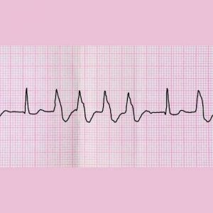 Ectopic Beats | Learn what they are & how you stop them