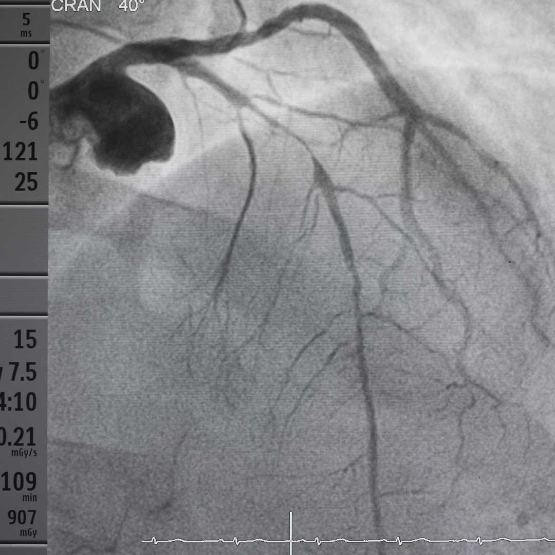 Heart Attack - Expert London Cardiologist for your Heart Health