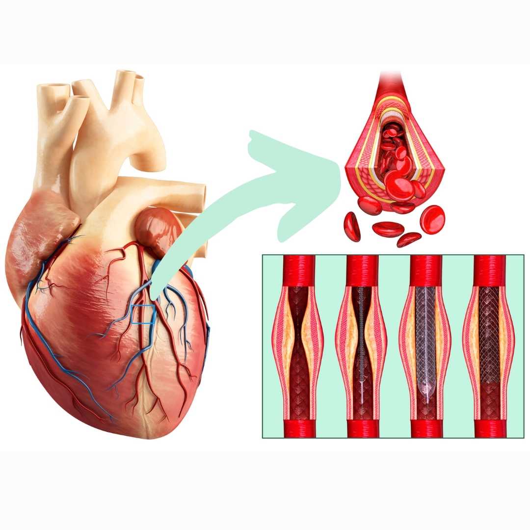 Heart Attack - Expert London Cardiologist for your Heart Health